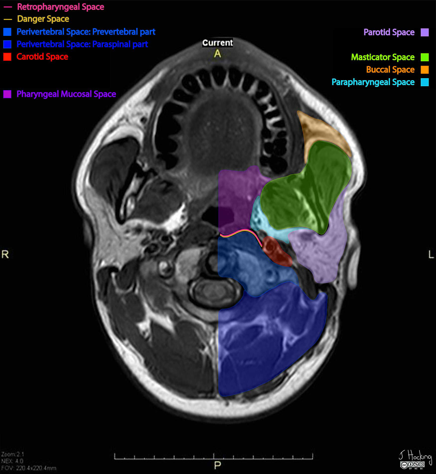 CT Neck Spaces Anatomy and Parapharyngeal Space Lesions - RADIOBITE