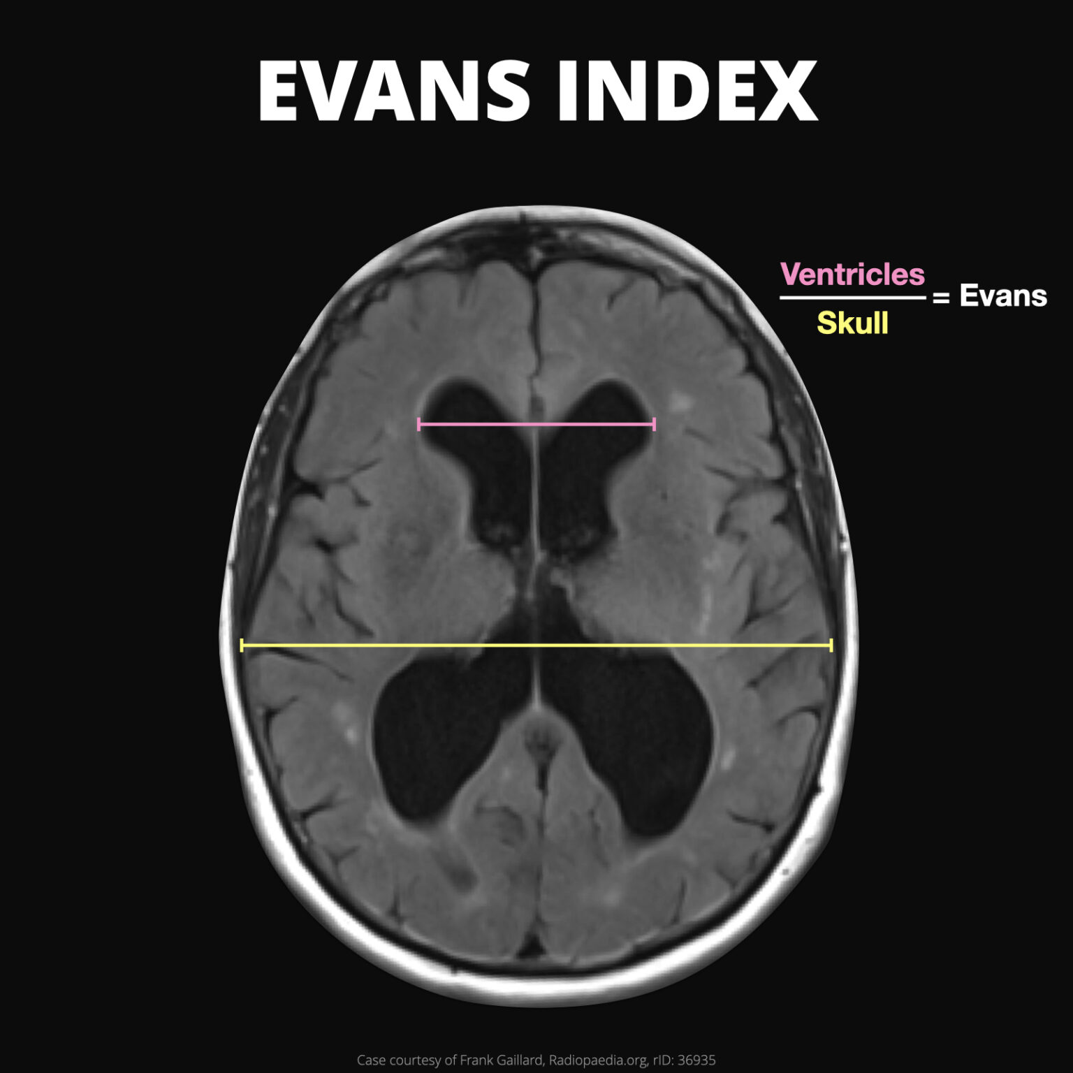 Imaging in Hydrocephalus: CT vs MRI - RADIOBITE